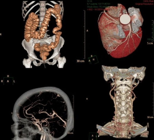 Tomografia 3d (TC 3D): Una visión tridimensional