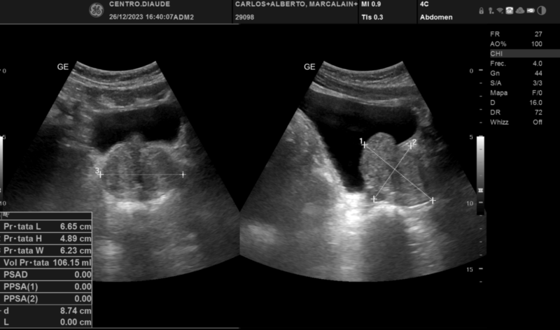 Ecografía Prostática y lo que deberías saber